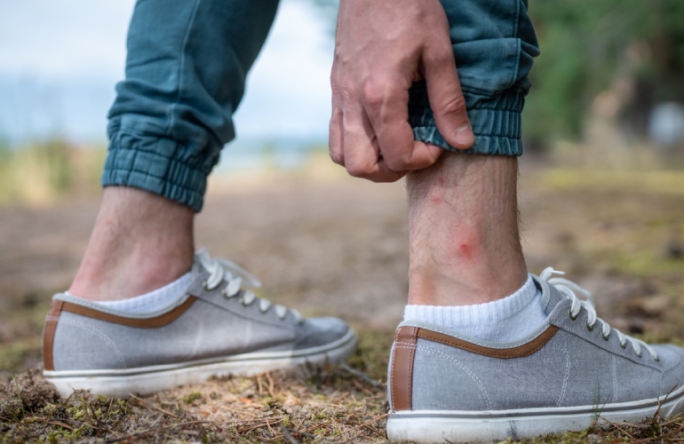 What causes the itch in mozzie bites? And why do some people get such a ...